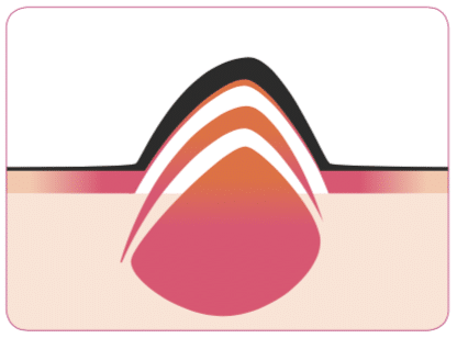 Abszesse und Furunkel • InfectoPharm Wissen wirkt.