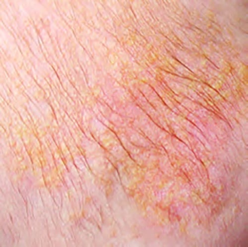 Milchschorf • InfectoPharm Wissen wirkt.