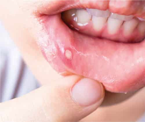 Aphthen • InfectoPharm Wissen wirkt.